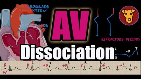 Av Dissociation Explained Classification Pathophysiology And Ecg