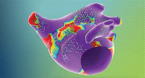 Abbott Receives Ce Mark For Its Volt™ Pulsed Field Ablation System To Treat Patients With