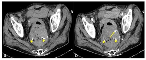 The Role Of Ct Angiography In The Acute Gastrointestinal Bleeding A