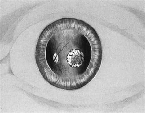Probably An Early Depiction Of Toxoplasmic Retinochoroiditis Taken Download Scientific Diagram