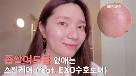 좁쌀여드름 없애는 스킨케어 루틴 ‼️ 아누아 어성초 토너 Youtube