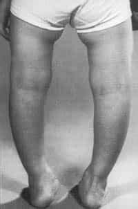 Las Piernas Arqueadas En Los Niños Bebés Y Embarazos