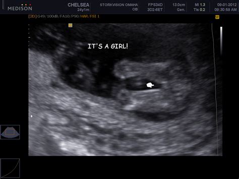 How Many Weeks Pregnant For Gender Ultrasound Igzzip