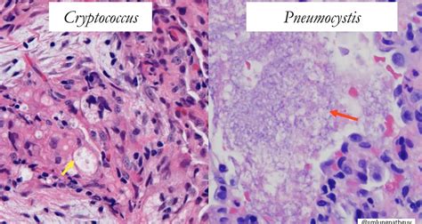 Cryptococcus Histology