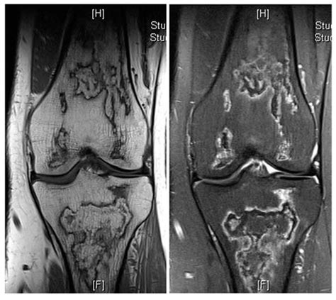 Revisiting Fat Content In Bone Lesions Paradigms In Bone Lesion Detection