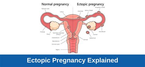 Ectopic Pregnancy Explained Aakash Healthcare