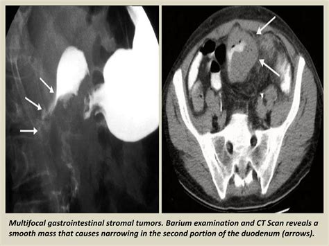 Presentation1 Radiological Imaging Of Gastro Intestinal Stromal Tumour Gist Pptx