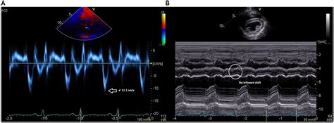 Tratamiento De La Epicarditis Constrictiva Mediante El Procedimiento De