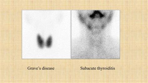 Interpretation Of Thyroid Function Tests And Scan Pptx Thyroid Disorders Endocrine And
