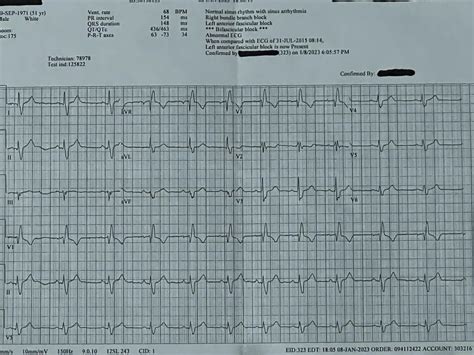 Ecg Thoughts Regular Bifascicular Block Or Proximal Lad What Do You Think R Ecg