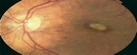 Radiation Maculopathy After Epimacular Brachytherapy For The