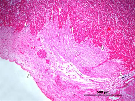 Endocardial And Subendocardial Fibrosis Arrows In Left Ventricle Endocardial And Subendocardial Fibrosis Arrows In Left Ventricle