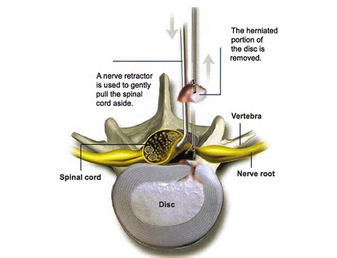 Lumbar Micro Discetomy Trimed Spine And Joint