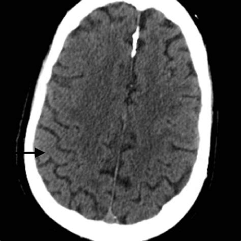 Computed Tomography Scan Of The Brain Showing Complete Resolution Of