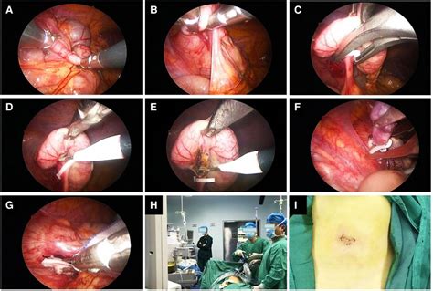 Open Appendectomy Incision
