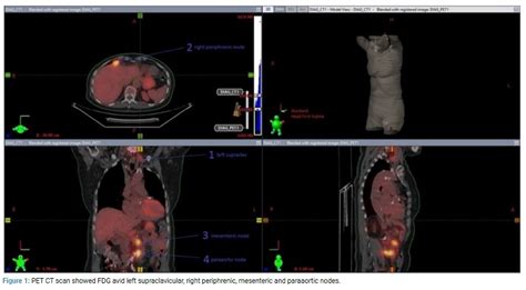 Extensive Refractory Isolated Multiple Nodal Recurrence Of Ovarian