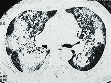 Thoracic Computed Tomography Showing Diffuse Alveolar Infiltrates