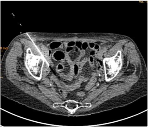 Computer Tomography Guided Icg Injection Into The Suspected Lesion Download Scientific Diagram