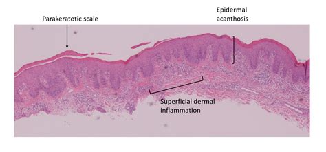 Your Pathology Report For Psoriasiform Dermatitis Mypathologyreport