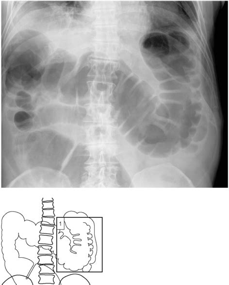 Bowel Obstruction X Ray