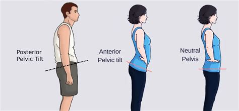 Anterior Vs Posterior Pelvic Tilt Difference Causes S