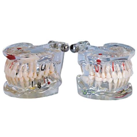 Pathology Teeth Model Manufacturers Supplier And Exporters In India