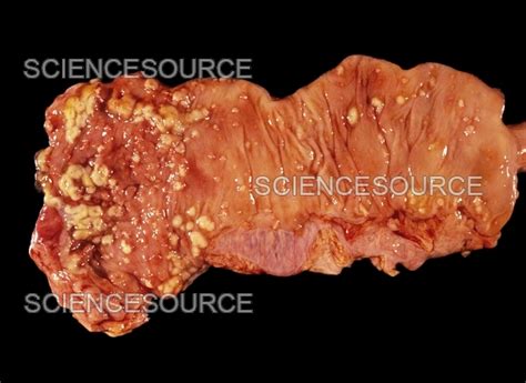 Proctitis Of The Rectum Stock Image Science Source Images