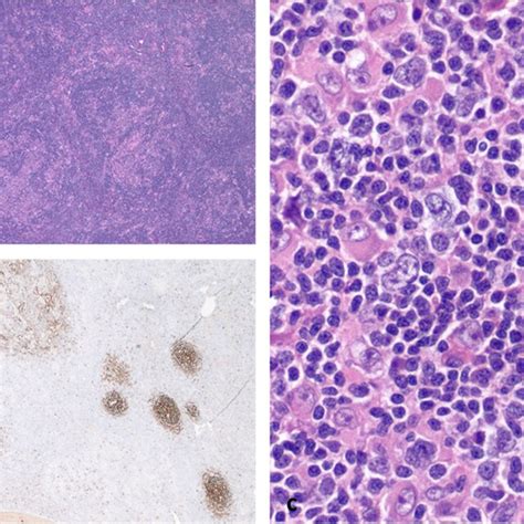 An Example Of Nodular Lymphocyte Predominant Hodgkin Lymphoma Download Scientific Diagram