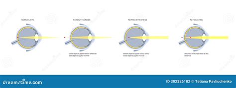 Astigmatism Disorder Medical Illustration 308476378