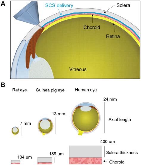 Retinal Restoration With 3d Printed Microneedles Tiny Tools Enable Giant Leaps In Medtech