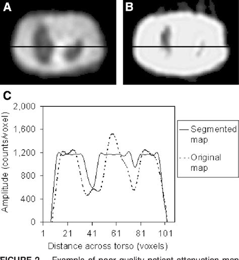 Figure 1 From Problems Created In Attenuation Corrected Spect Images By
