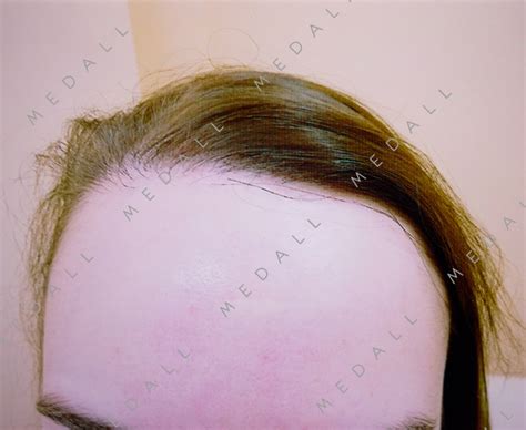 Коррекция линии роста волос пересадкой фото до и после результаты