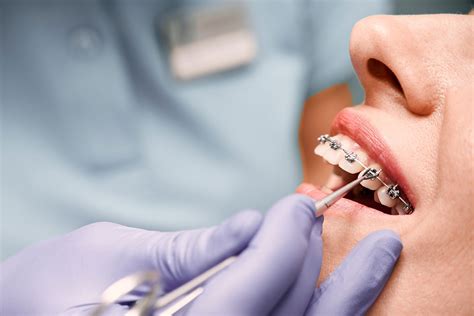 What Are The Benefits Of Orthodontic Treatment Somerset Dental On James