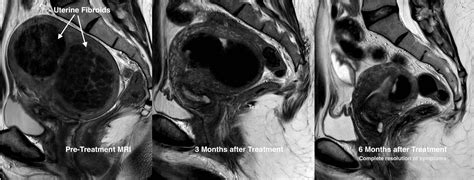 Varicocele Embolisation Lumina Interventional Radiology