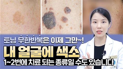 색소성 병변의 모든 것 ⭐리팟레이저⭐로 걱정 없이 치료 가능 👩‍⚕️ Feat 흑자 검버섯 기미 잡티 주근깨 Youtube
