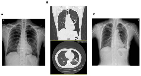 Iatrogenic Pneumothorax During Acupuncture Case Report