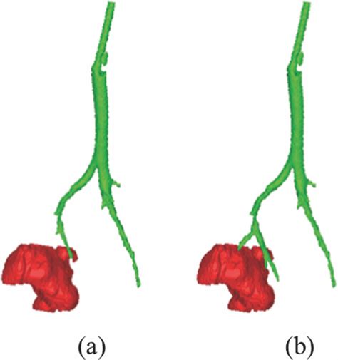 Airway Extraction Result A Without And B With Local Refinement Download Scientific Diagram