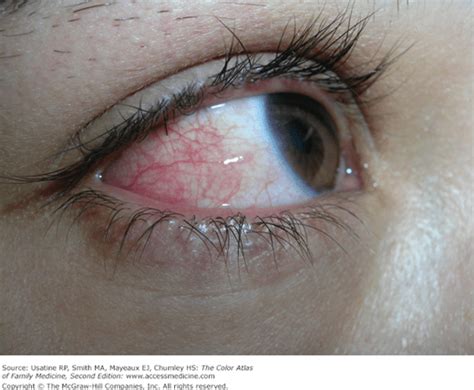 Scleral And Conjunctival Pigmentation Basicmedical Key