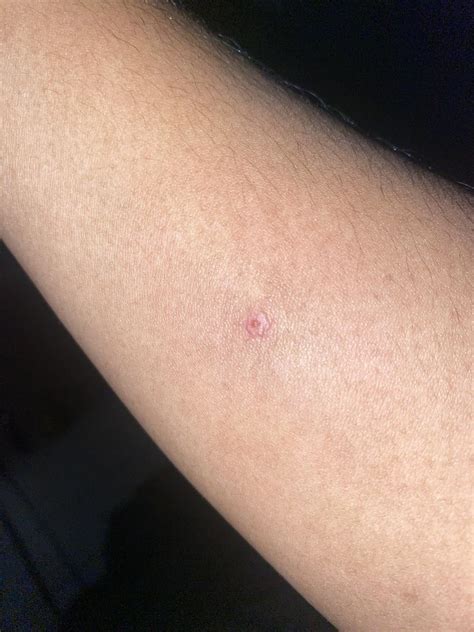 Bug Bite Or Staph Infection R Bugbites