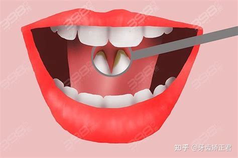 牙齿缝隙有黑黑的抠不下来这些方法可以帮你祛除黑线 知乎