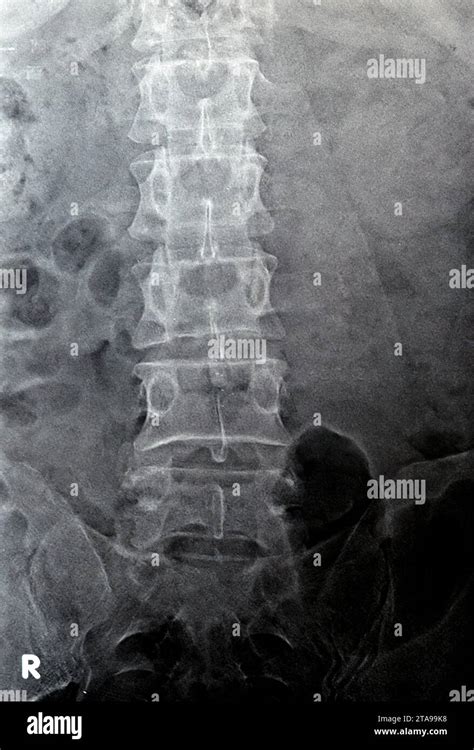 Plain X Ray Lumbosacral Spine Revealed Straightened Mild Scoliotic