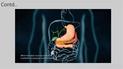 Procedure Of Ercp And T Tube Cholangiography Ppt