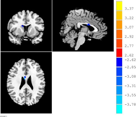 Figure 1 From Abnormal Regional Homogeneity In Right Caudate As A