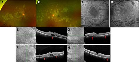 Patient 2 A B Ultrawide Field Fundus Color Imaging Showed Download Scientific Diagram