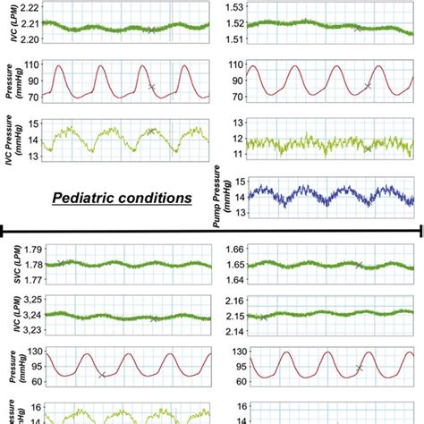 Sample Hemodynamic Waveforms Established For The Single Ventricle