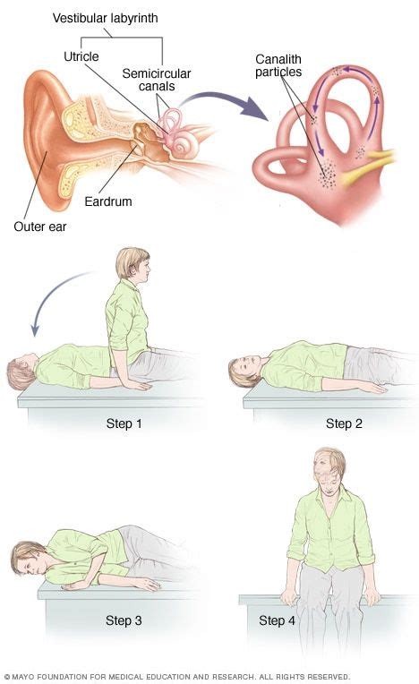 Canalith Repositioning Procedure Artofit
