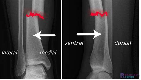 Fracture General Principles