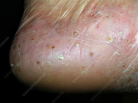 Palmoplantar Psoriasis Stock Image C056 4940 Science Photo Library