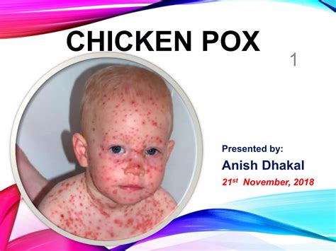 Chicken Pox Varicella And Herpes Zoster Pptx