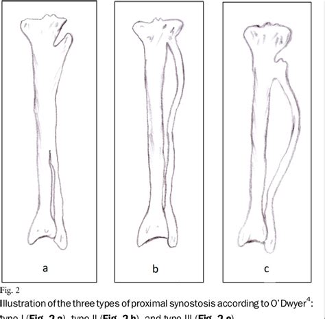 Figure 2 From Proximal Tibiofibular Synostosis In A Professional Soccer Player A Case Report
